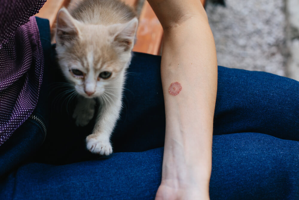 A guide to ringworm vs eczema - VSM Pharmacy